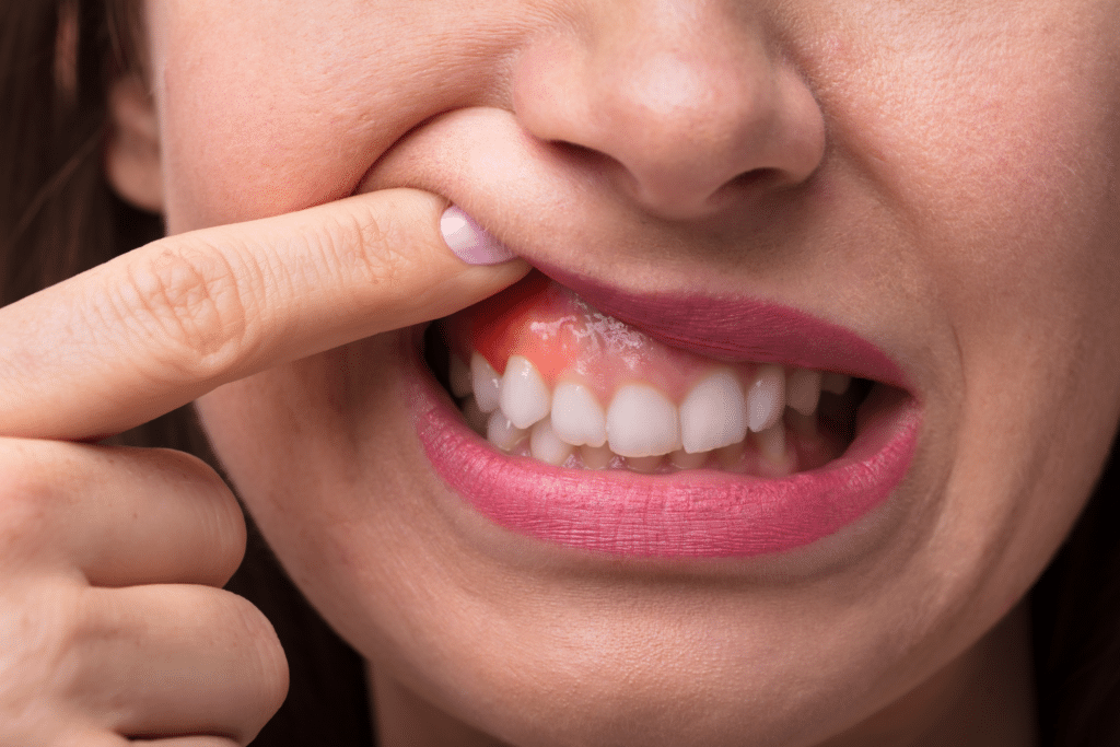 Understand Gingivitis: Causes, Symptoms, and Treatment Options