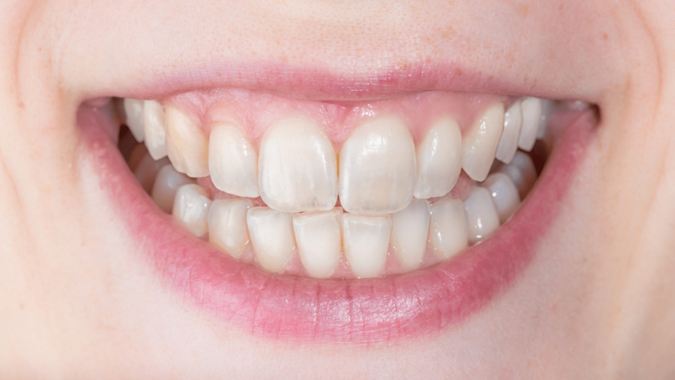 Are Translucent Teeth a Sign of Bad Oral Health?