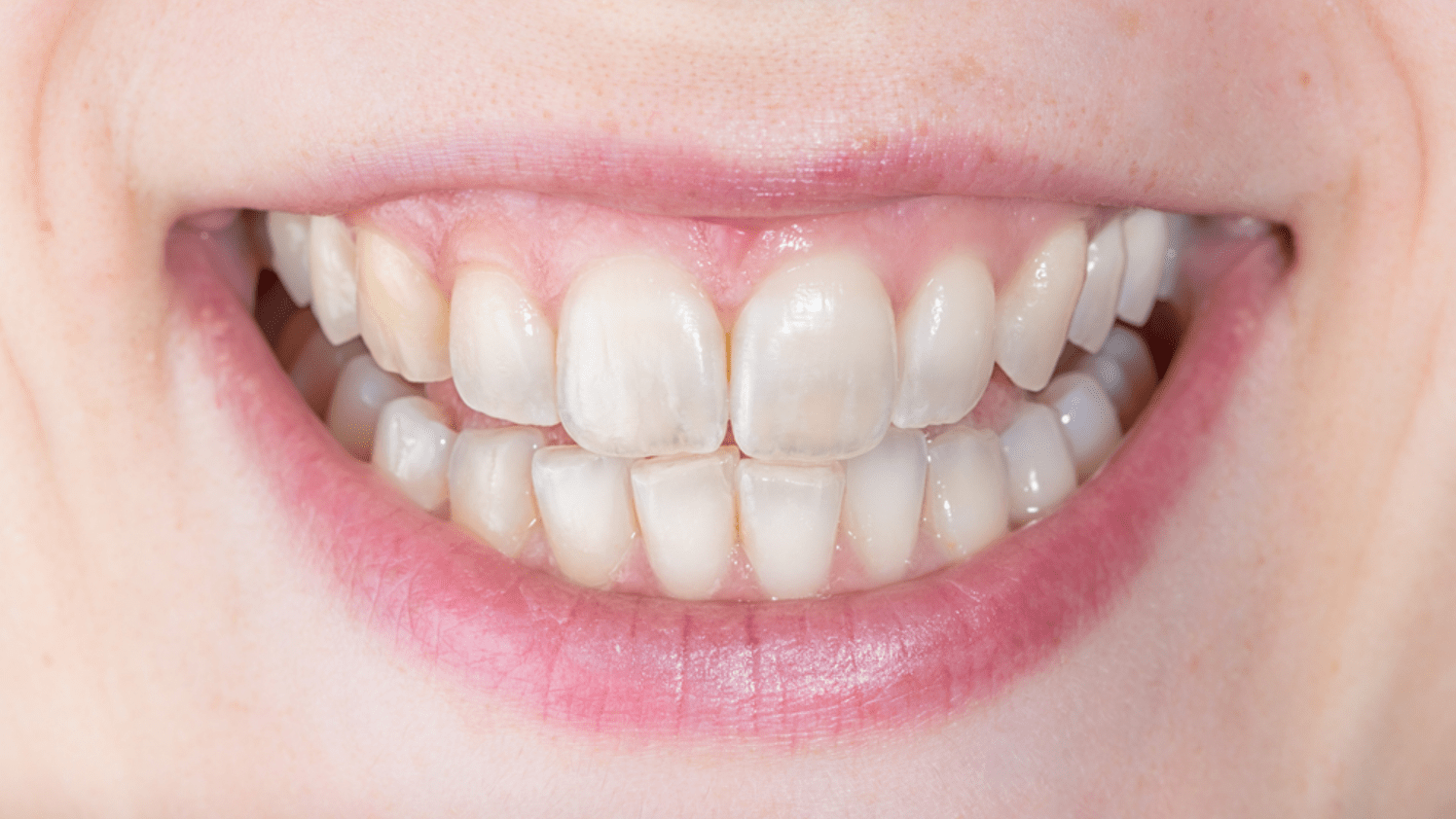 Are Translucent Teeth a Sign of Bad Oral Health?